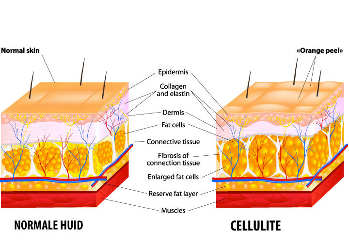 Helpt krachttraining tegen cellulite? - FIT.nl